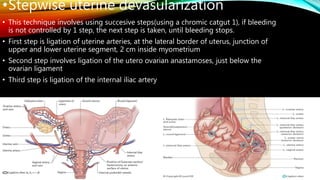 Post Partum Haemorrhage (B-Lynch, Stepwise uterine devascularization) | PPTX