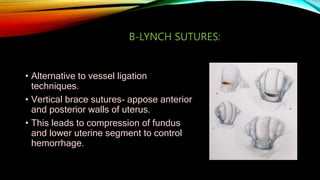 Postpartum hemorrhage | PPTX | Reproductive Health | Diseases and ...