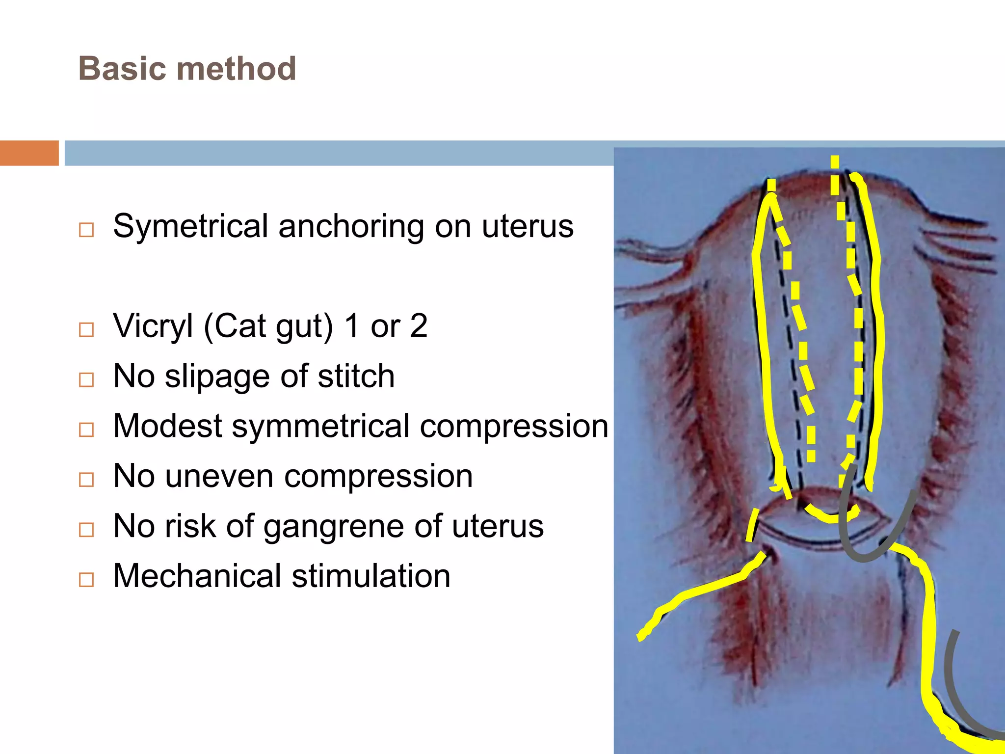 KỸ THUẬT B LYNCH | PDF