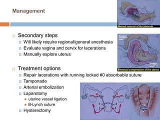 KỸ THUẬT B LYNCH | PDF
