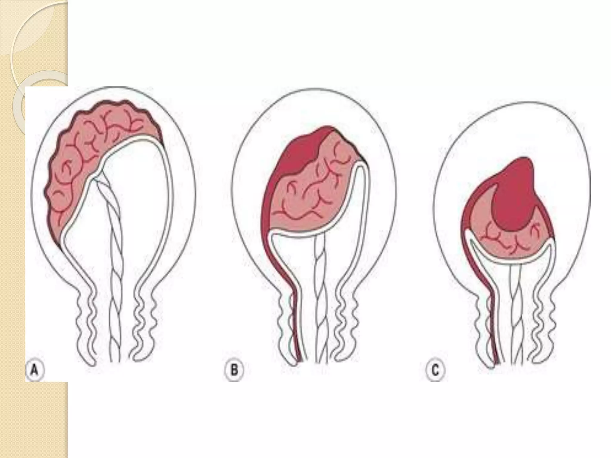 post partum haemorrhage | PPTX