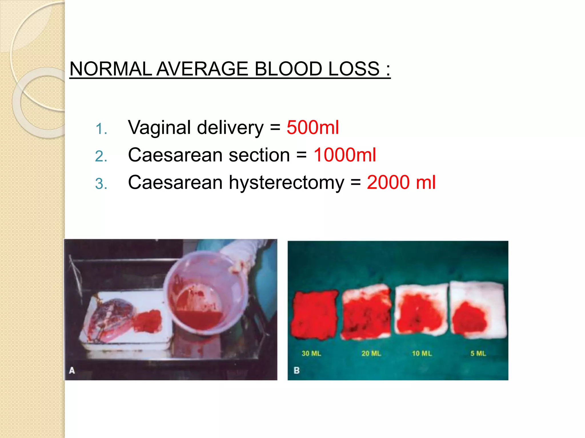 post partum haemorrhage | PPTX