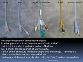 Baloon tamponade in management of postpartum haemorrhage | PDF