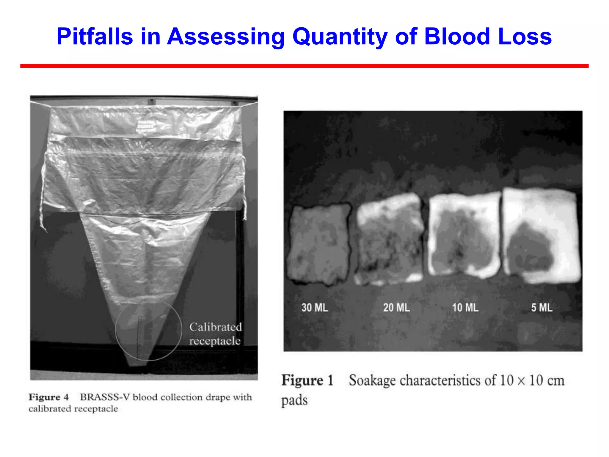 Management of Post-partum hemorrhage (PPH) | PPTX