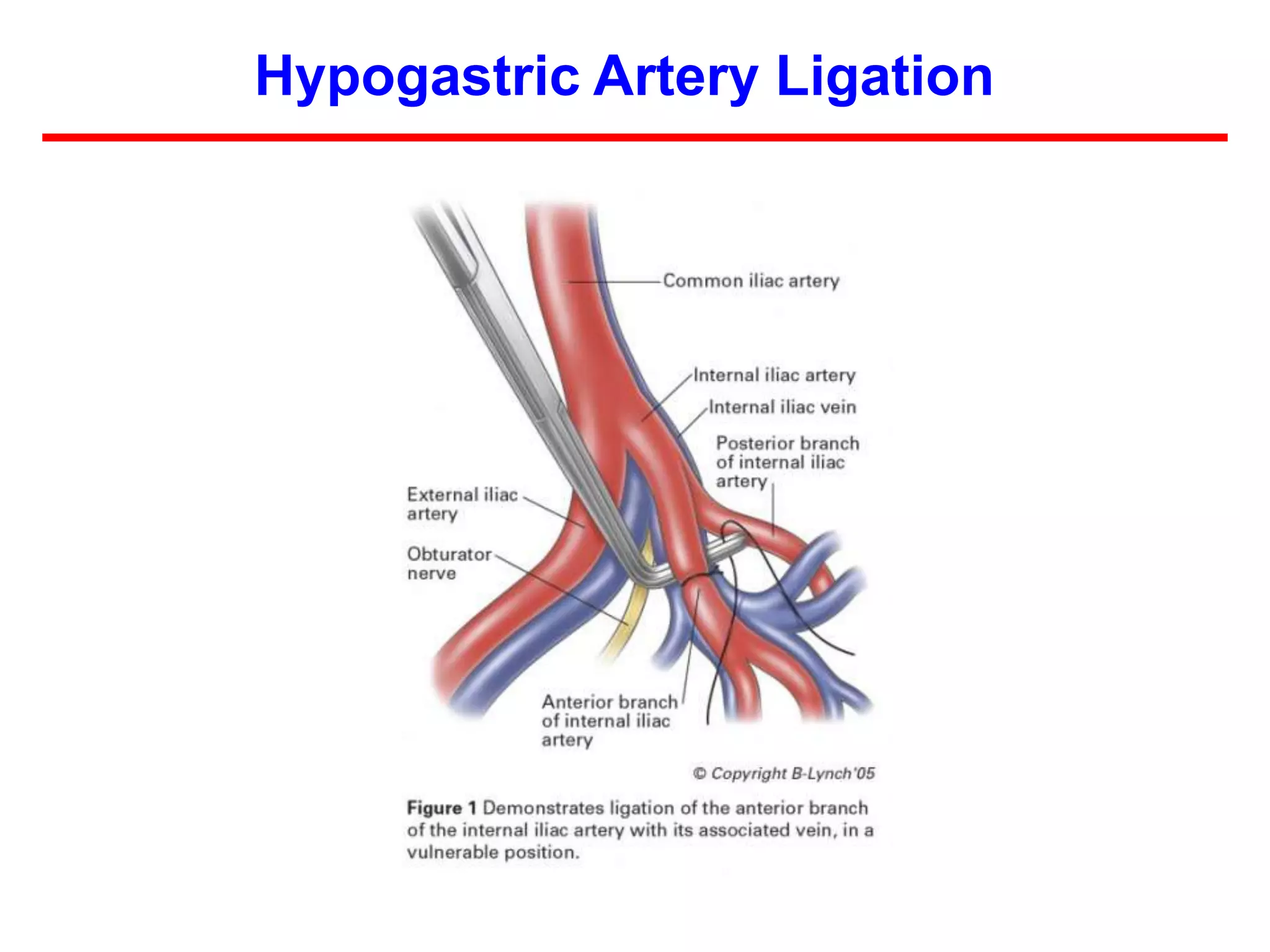 Management of Post-partum hemorrhage (PPH) | PPTX
