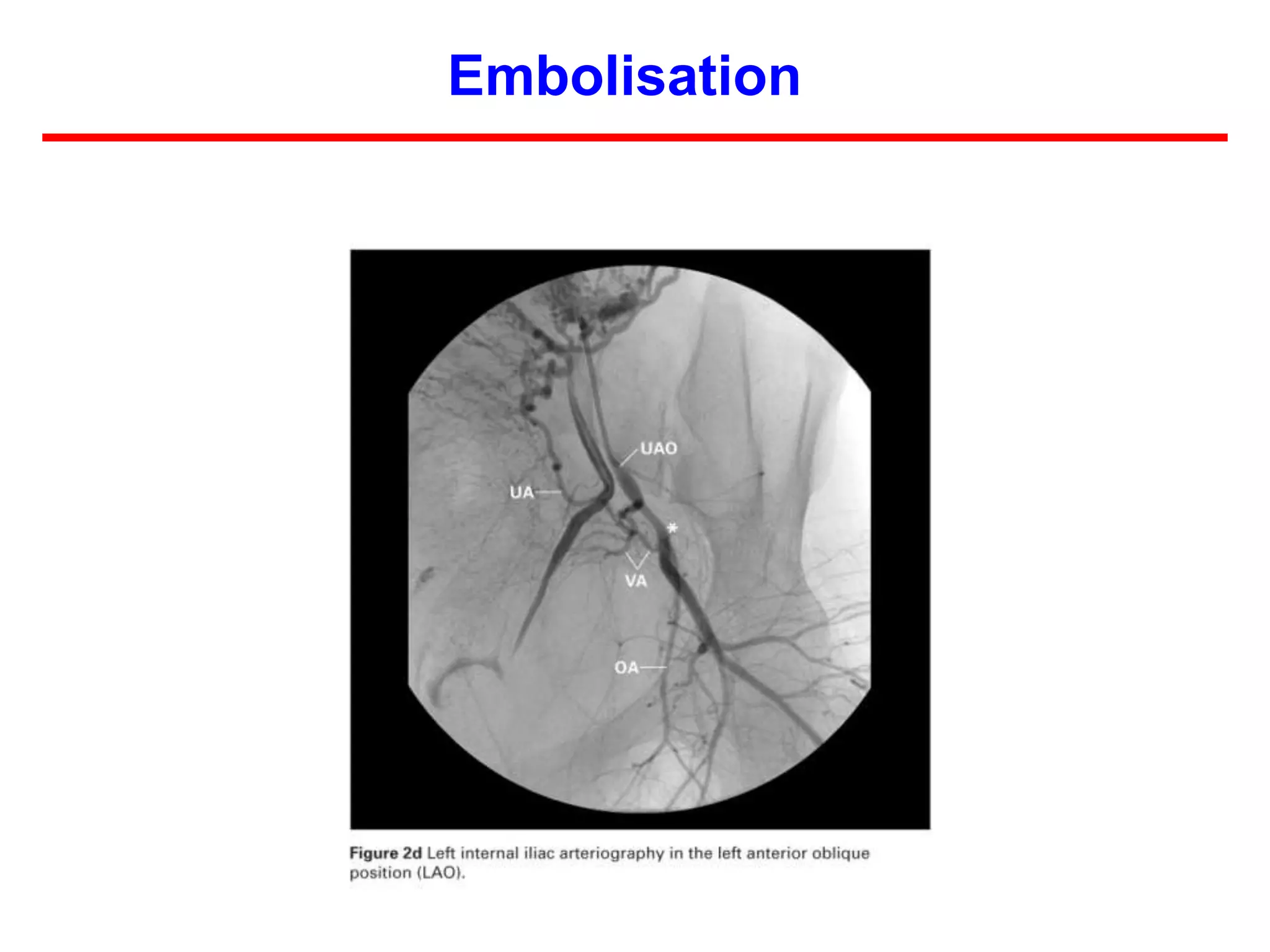 Management of Post-partum hemorrhage (PPH) | PPTX