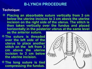Pph managment rabi | PPT