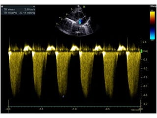 PPHN -pathophysiology and management | PPTX