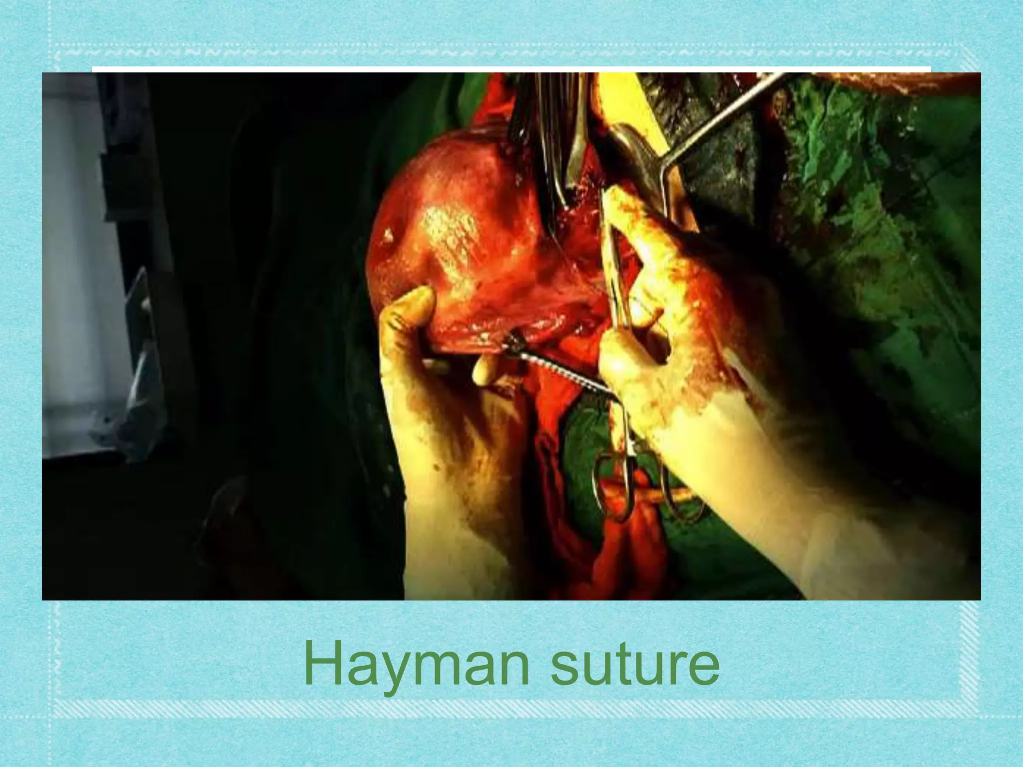 Surgical Management of Postpartum Hemorrhage | PPTX