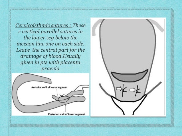 Normal Bleeding After C Section
