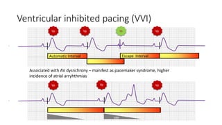 Pacemaker timing cycle harsh.pptx
