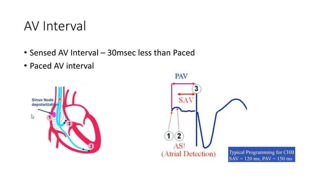 Pacemaker timing cycle harsh.pptx