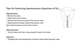 PPIUCD!!!.pptx obstetrics and gynaecology | PPTX
