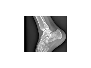 Calcaneus osteosynthesis with O-arm | PDF
