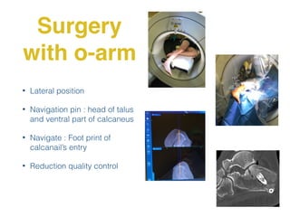 Calcaneus osteosynthesis with O-arm | PDF