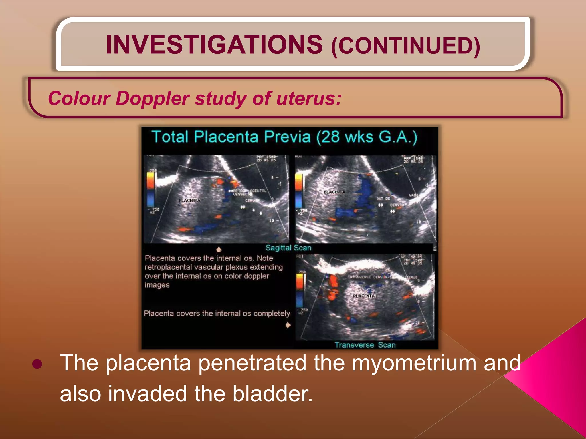 Anaestehsia for Cesarean section in a patient with Central Placenta ...