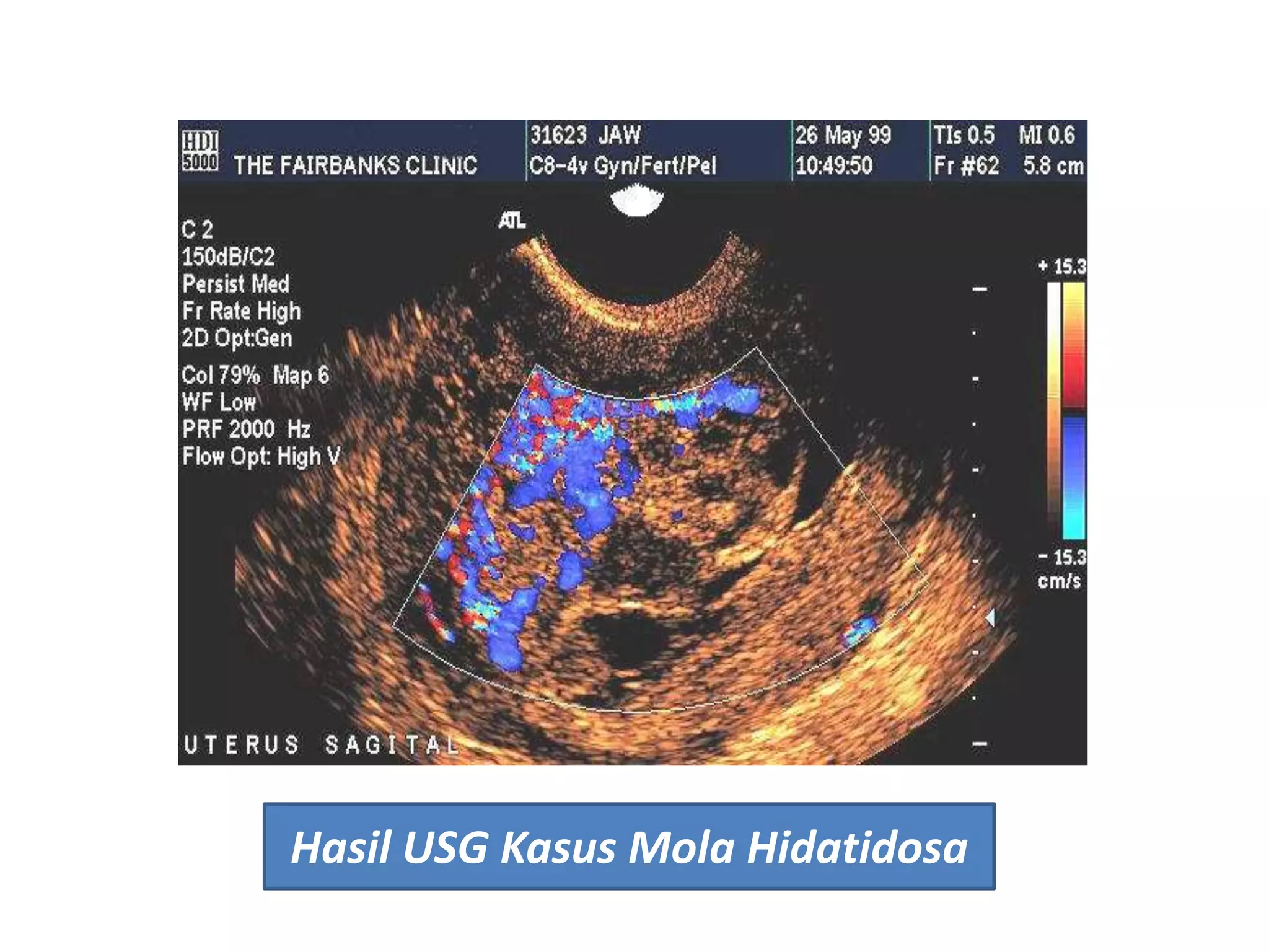 mola hidatidosa | PPTX