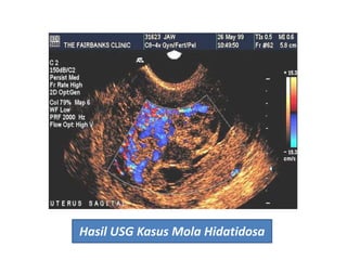 mola hidatidosa | PPTX