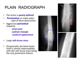 Ewing Sarcoma X Ray