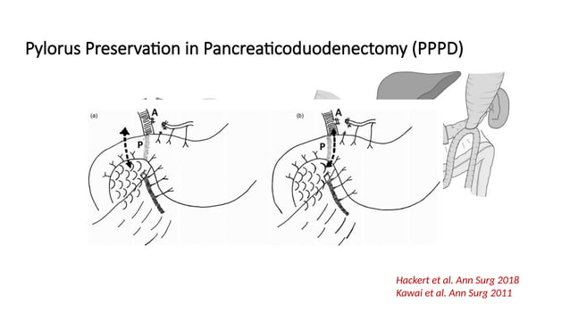 pylorus preseving pancreaticoduodenectomy.pptx