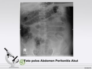 Tanda dan Gejala Peritonitis pada Anak.ppt