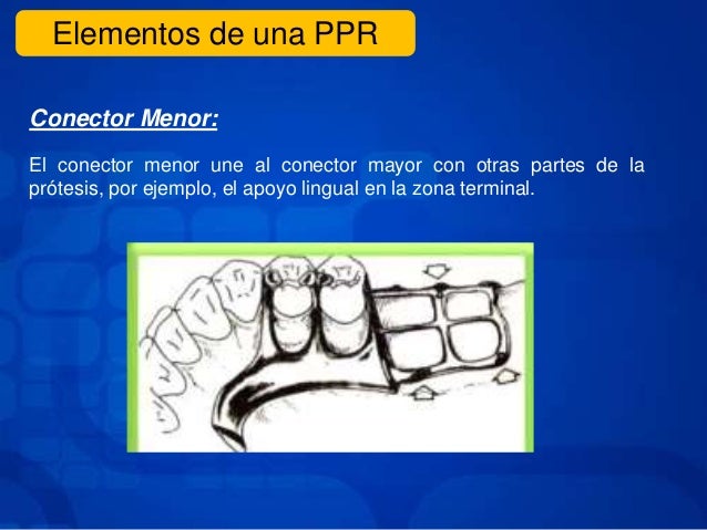 Protesis Parcial Removible