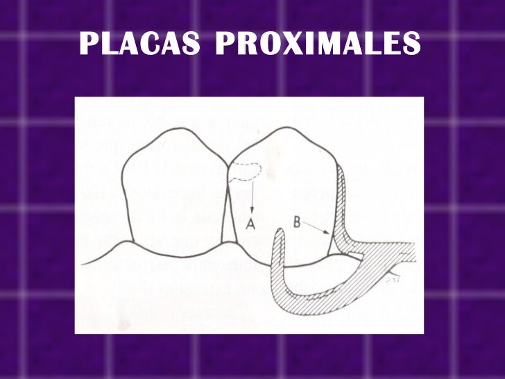 Prótesis Parcial Removible, estudio y diseño