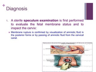 Preterm Premature Rupture Of Membranes (PPROM) | PPTX