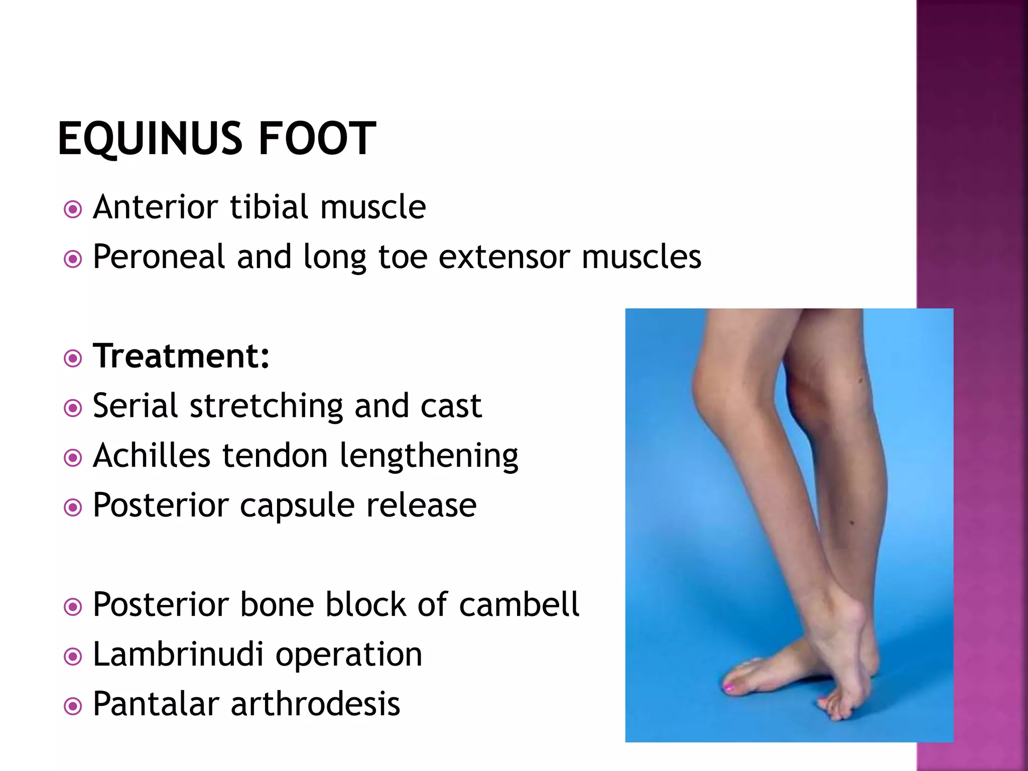 post polio residual paralysis | PPTX