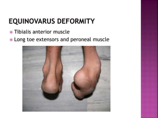 post polio residual paralysis | PPTX