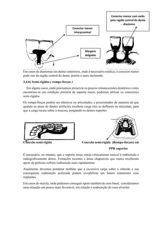 PPR(prótese parcial removivel) RESUMO.pdf