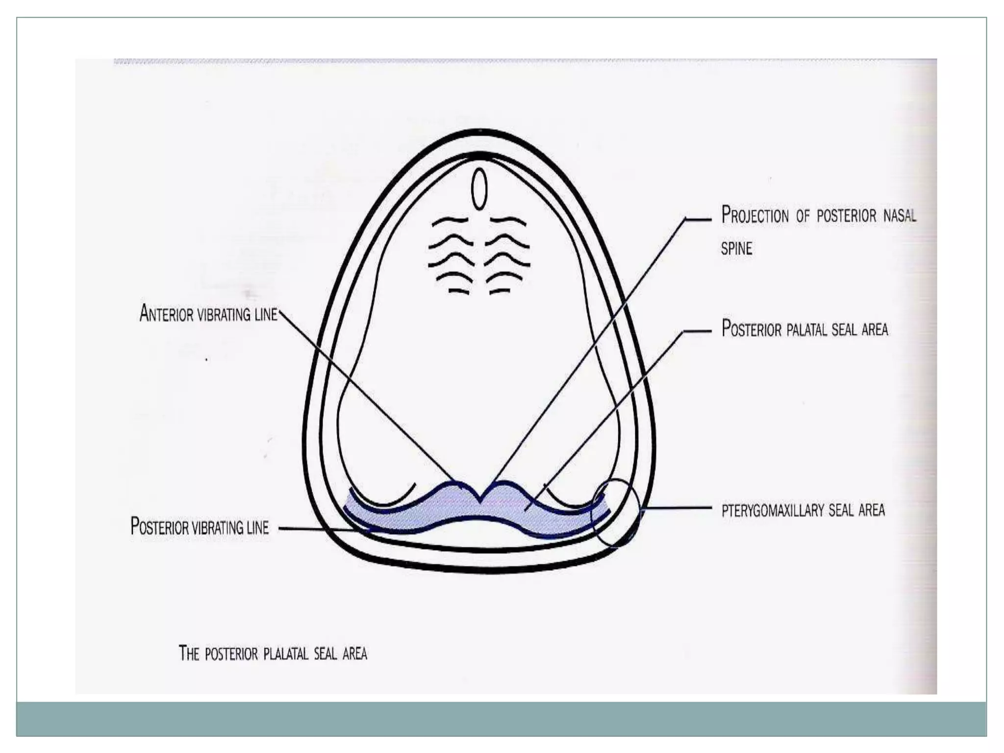 POSTERIOR PALATAL SEAL AREA | PPTX