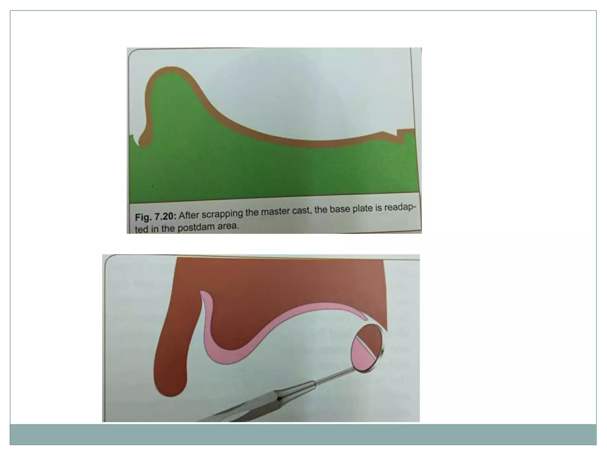 POSTERIOR PALATAL SEAL AREA | PPTX