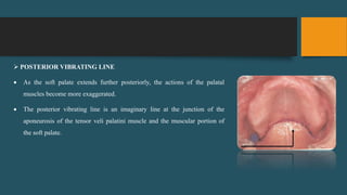 Fovea Palatini Vibrating Line