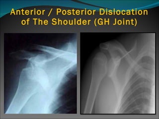 Ppshoulder | PPT