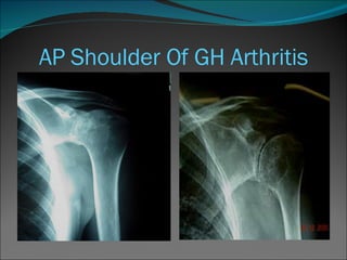 Ppshoulder | PPT
