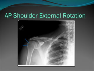 Ppshoulder | PPT