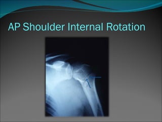Ppshoulder | PPT