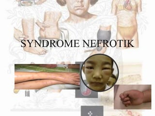 Ppt sindrom nefrotik | PPTX