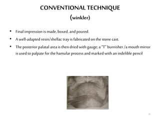 posterior palatal seal | PPTX