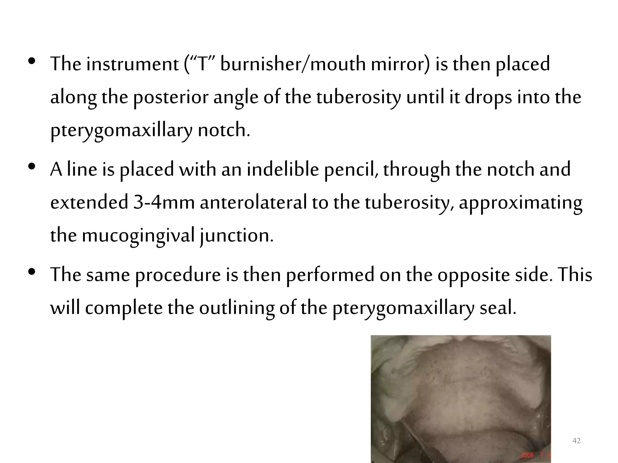posterior palatal seal | PPTX