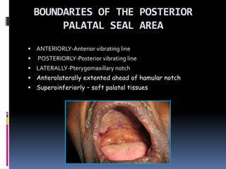 PPS PROSTHODONTICS | PPTX
