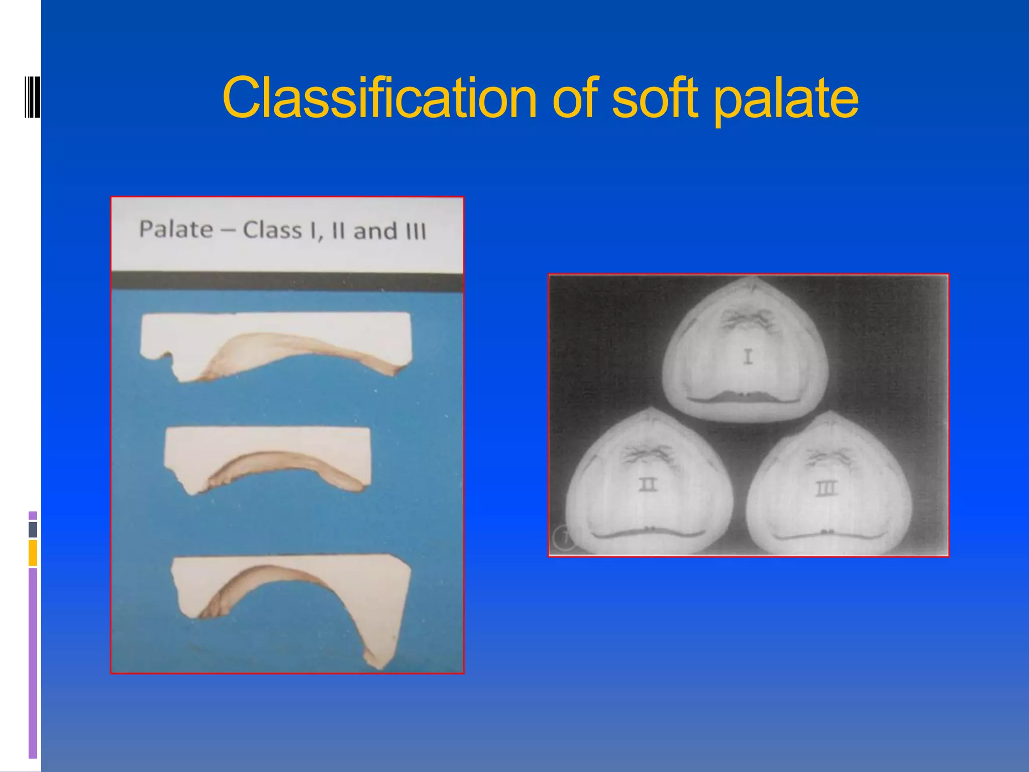 posterior palatal seal ppt | PPTX