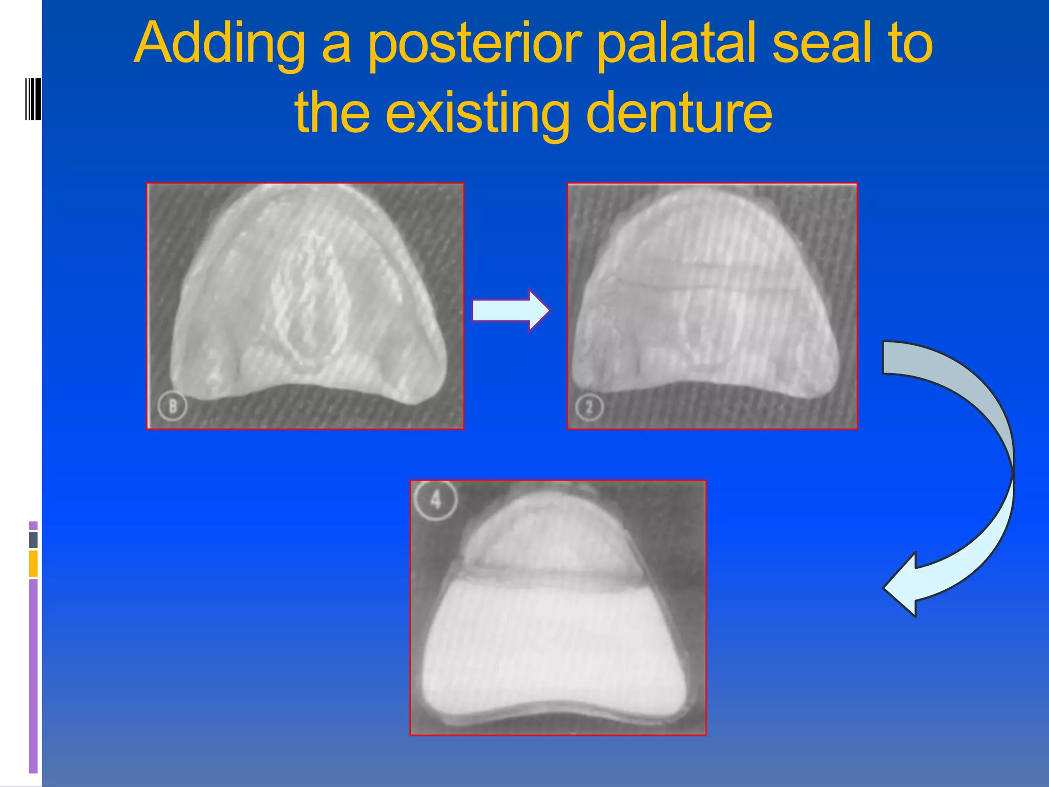 posterior palatal seal ppt | PPTX