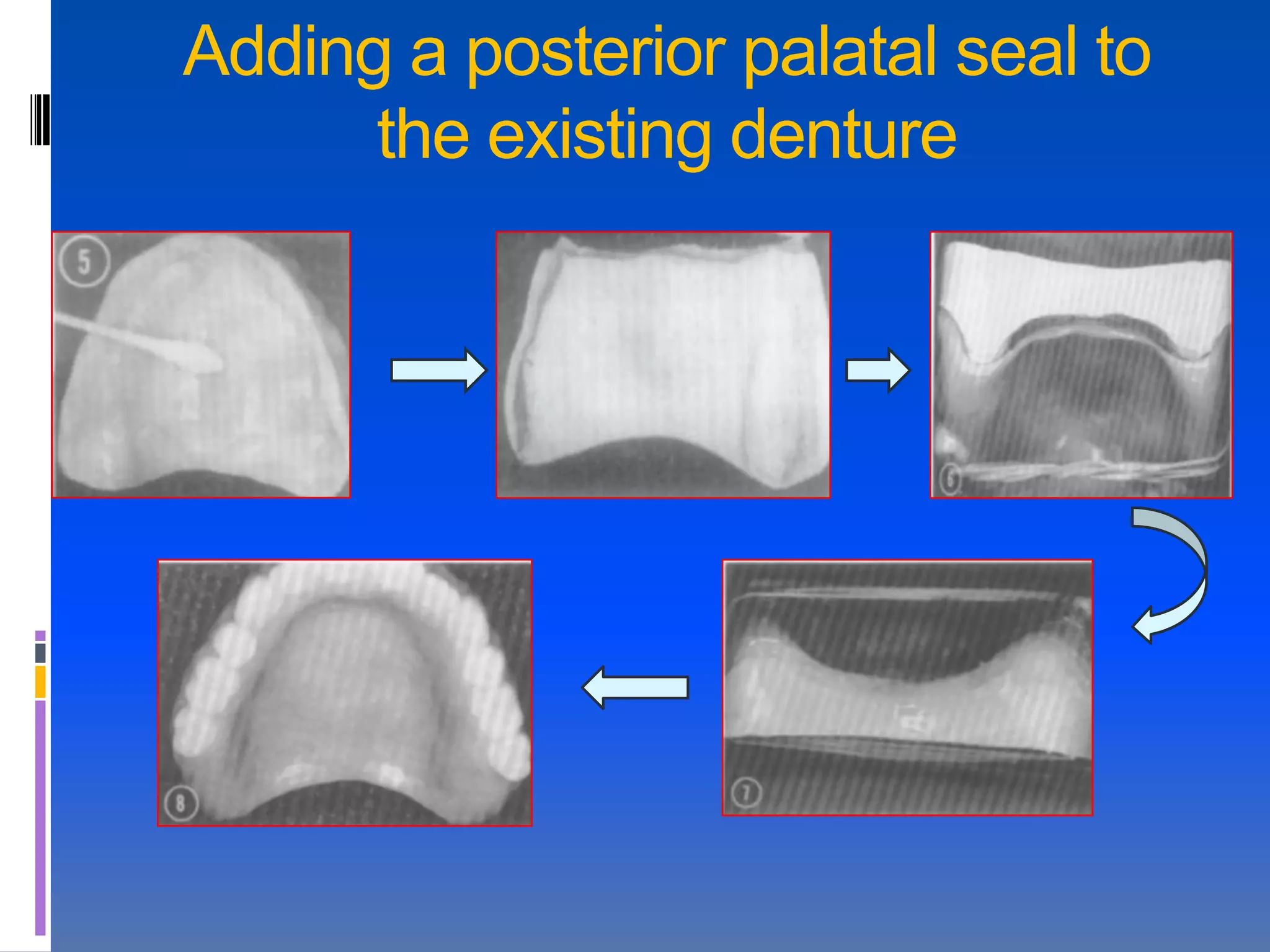 posterior palatal seal ppt | PPTX