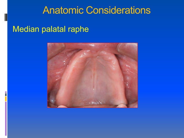 posterior palatal seal ppt | PPTX