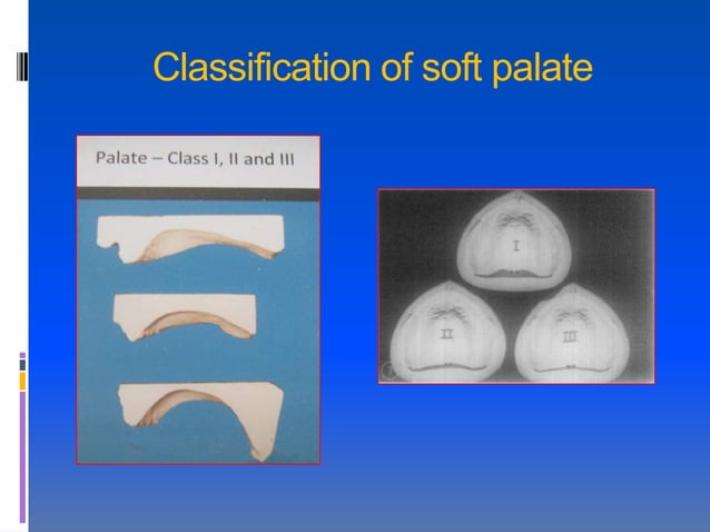 posterior palatal seal ppt | PPTX