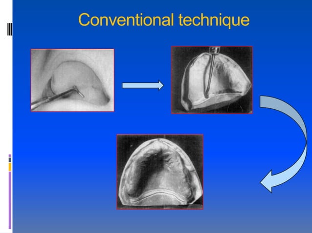 posterior palatal seal ppt | PPTX