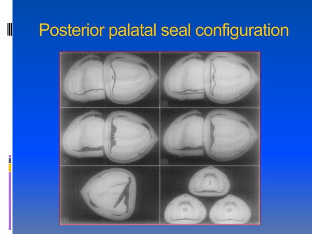 posterior palatal seal ppt | PPTX
