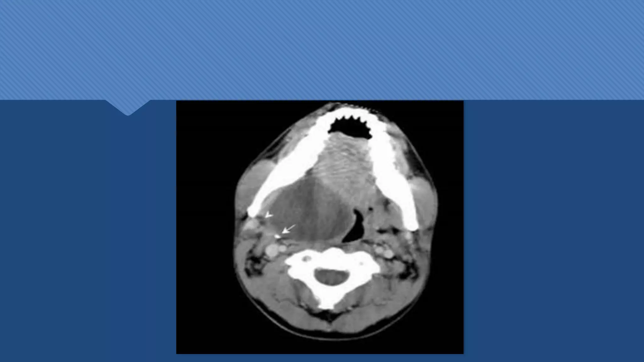 parapharyngeal space tumors | PPTX